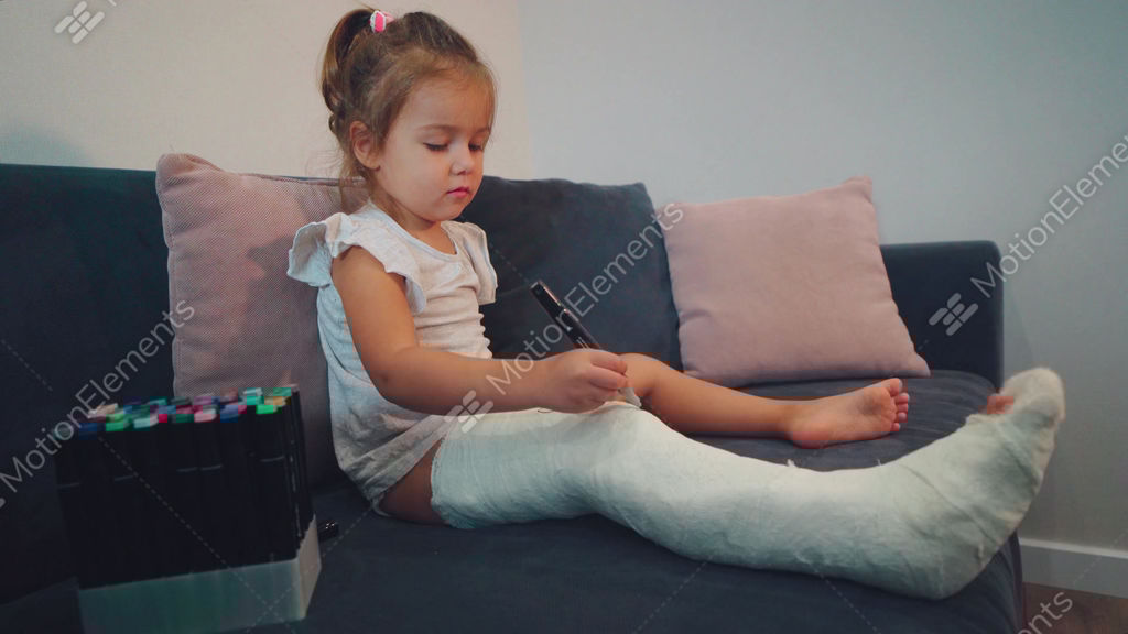 Broken Femur Bone Cast